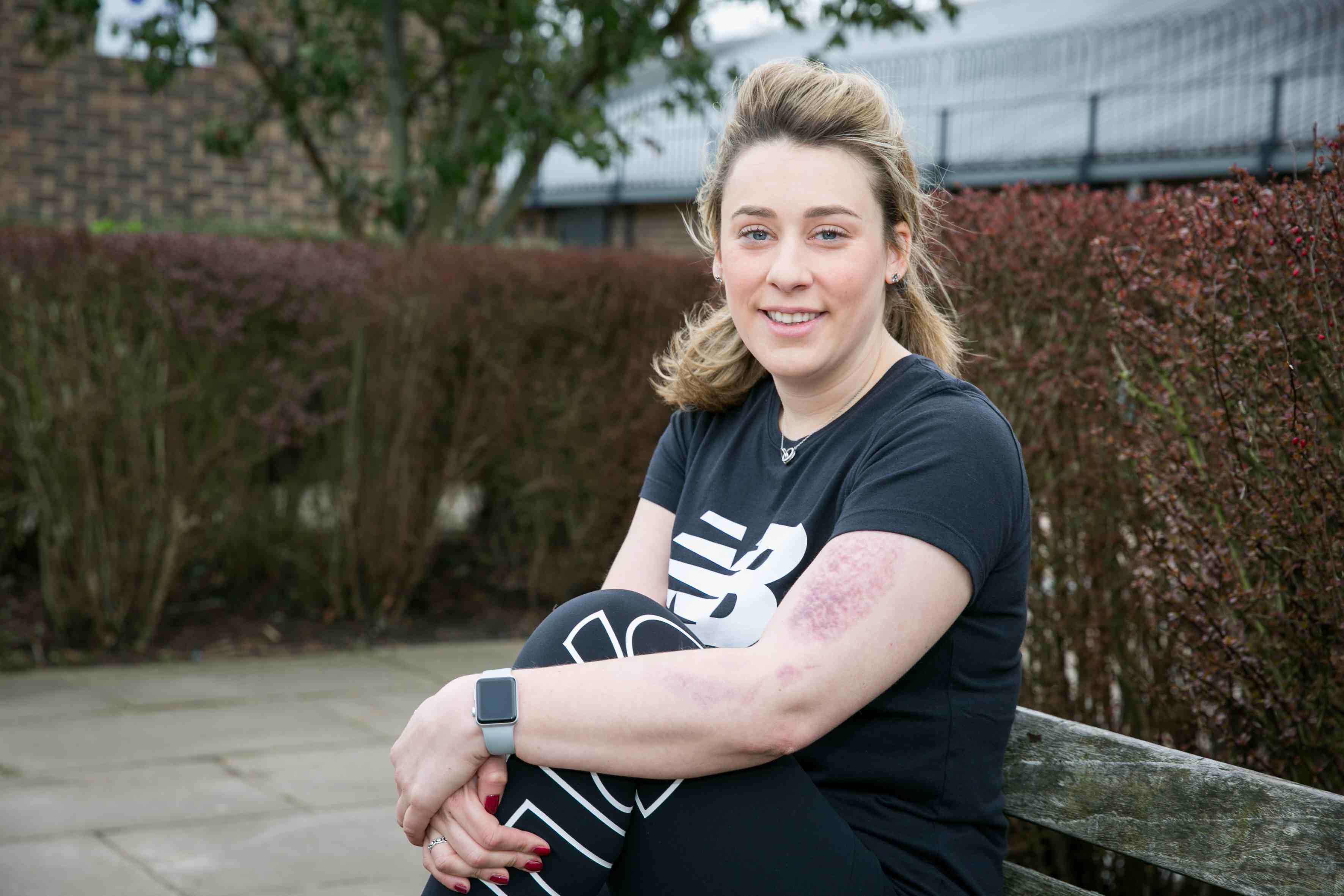 Police officer who fell into barbecue to run marathon for burns victims ...